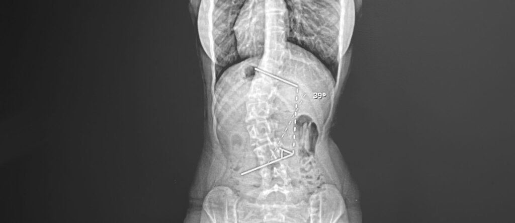 Scoliosis Awareness – Marta Eliza Miller Foundation